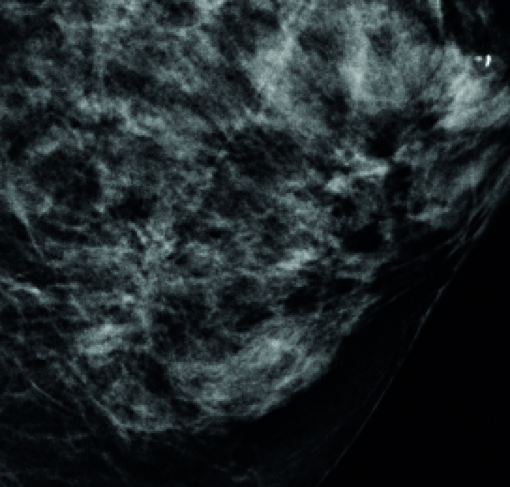 Selenia Dimensions 3D Mammography - Mammografia 3D